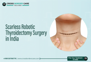 Scarless Robotic Thyroidectomy Surgery